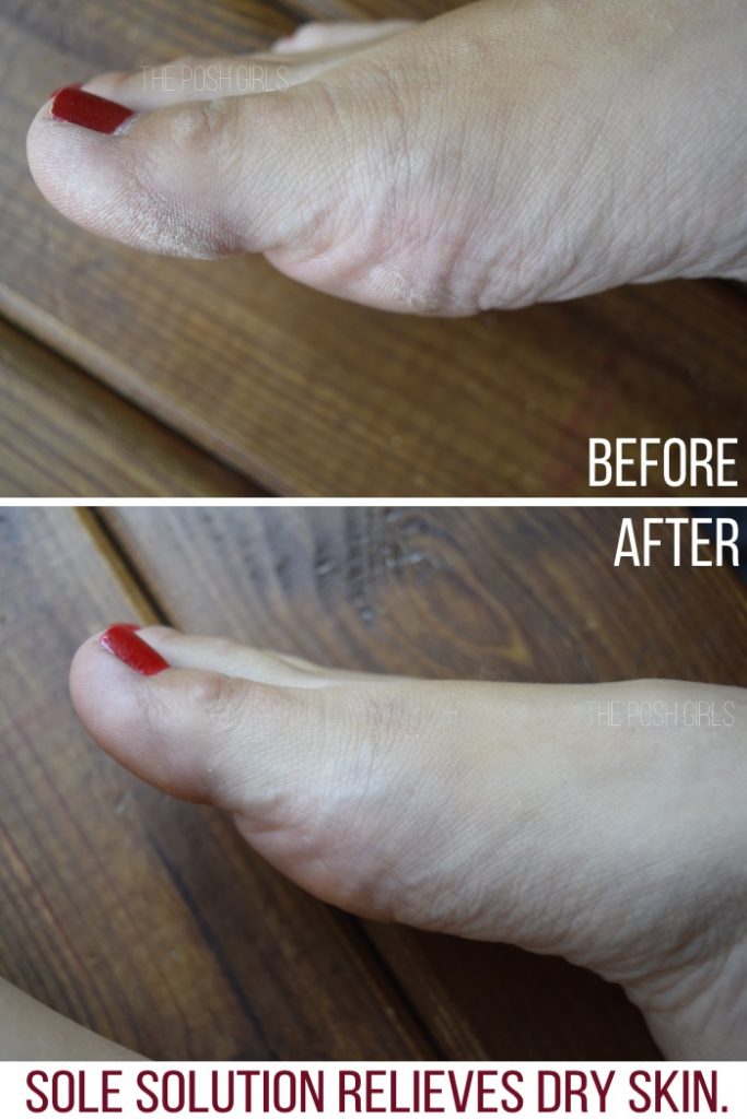 The Solution for Dry, Cracked Feet is Here!